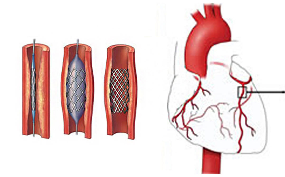 #Best Coronary Angiography Surgeon & Doctors in Khar, Mumbai | Dr ...