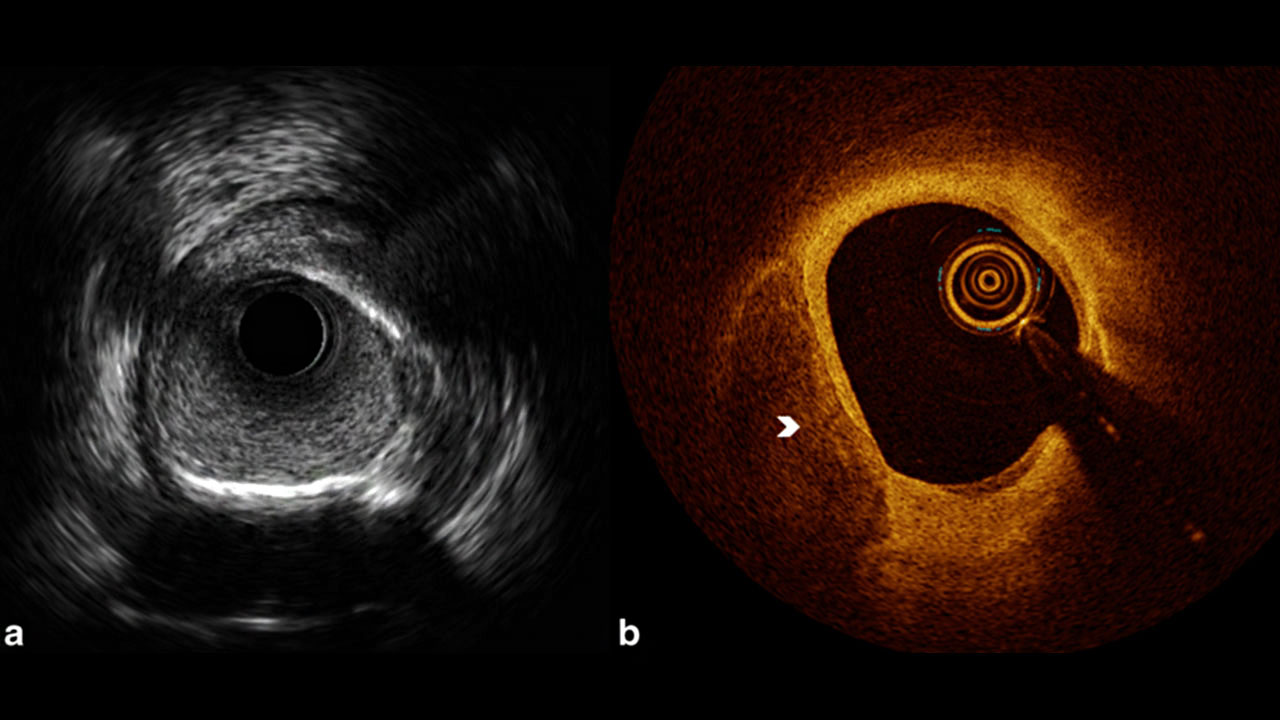 #Best Doctor For Heart Bypass Surgery in Khar, Mumbai | Dr.Suresh G Vijan