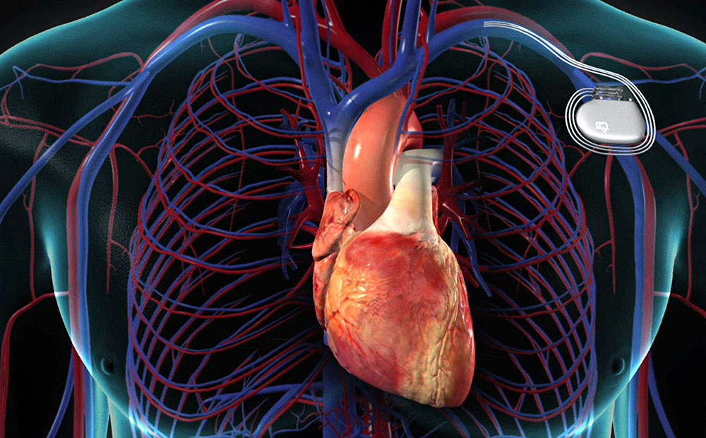 #Best Pacemaker Surgery Doctors/Implantation Surgeons in Khar, Mumbai ...
